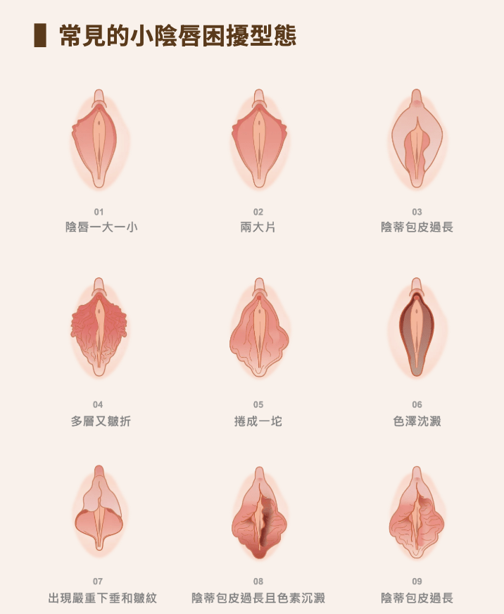 小陰唇過長好困擾💢美無極小陰唇整形還你漂亮小陰唇形狀 - 品牌商家可以色色 (@nsfw_selection) | Dcard