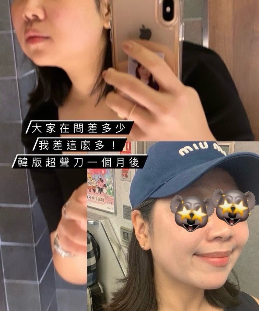 #分享 關於上個禮拜在韓國做過的醫美 - 韓國旅遊板 | Dcard