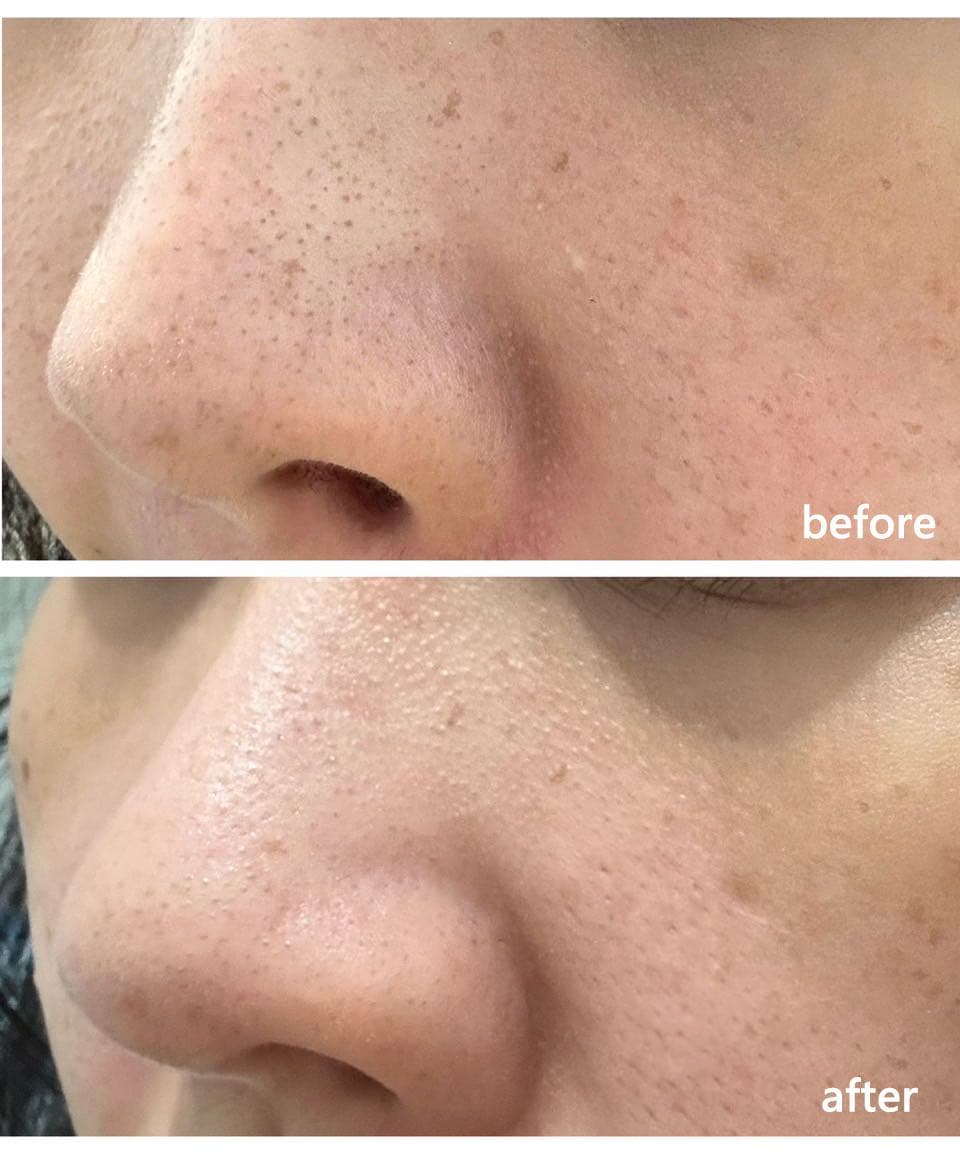 #分享 萬年黑頭少超多! SOFINA iP毛孔極淨黑凝膠 - 美妝板 | Dcard