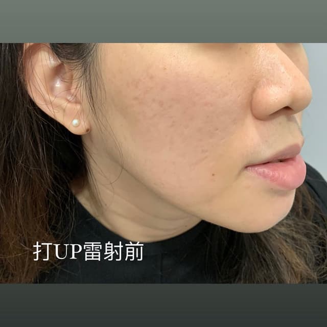 #討論 打完UP雷射皮膚變得更差了 - 醫美板 | Dcard