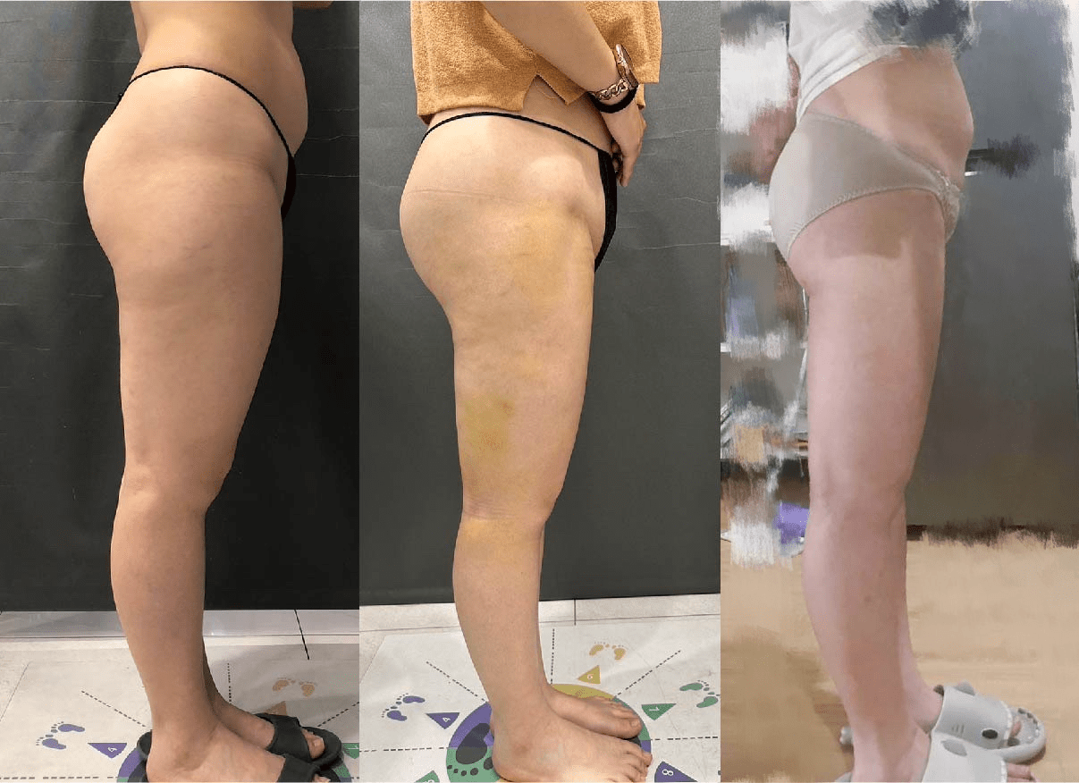 #分享 我不想再當米其林寶寶啦！！ - 晶美整形 (@skin1000) | Dcard