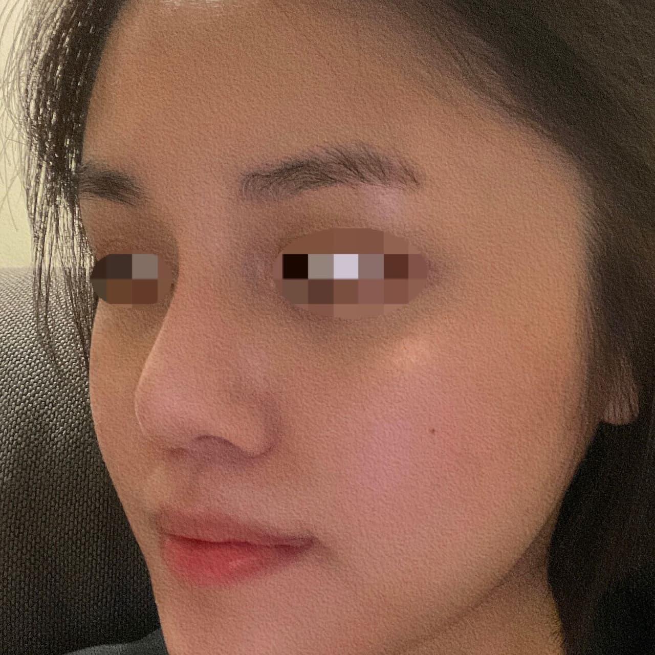 #分享 隆鼻心得全記錄*更 - B77 留言 | Dcard