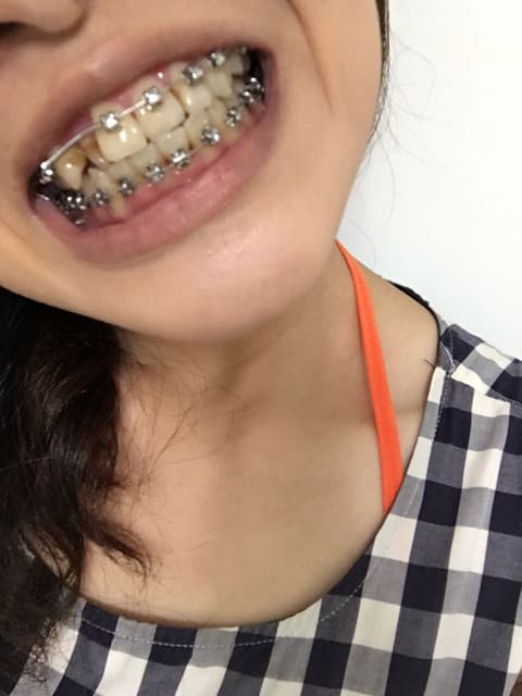 牙套1355days 依然ing🥰 - B8 留言 | Dcard