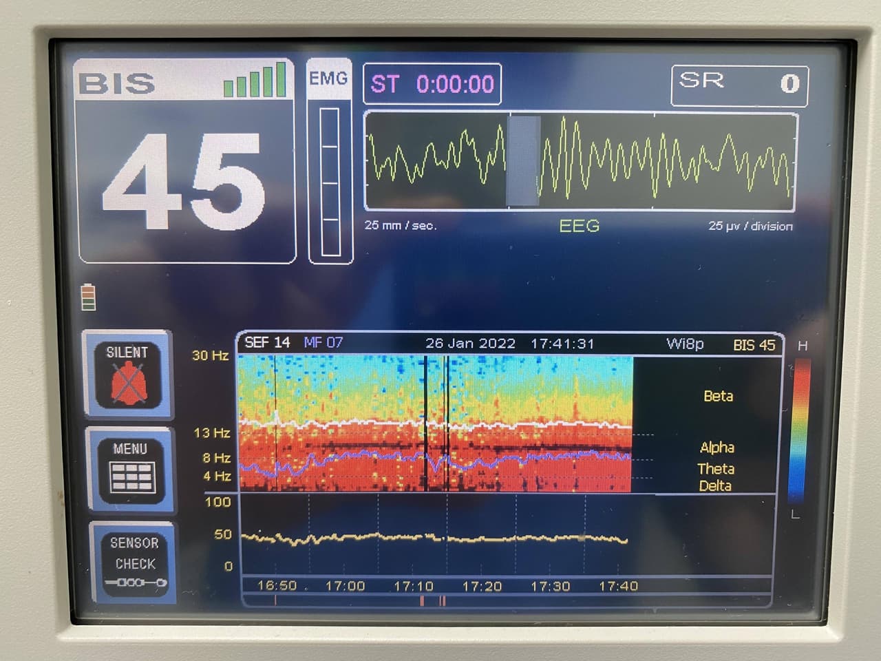 #分享 麻醉深度偵測儀(BIS+DSA) - 醫美板 | Dcard