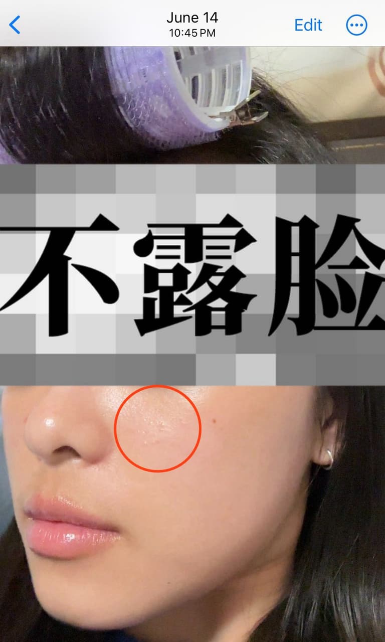 #分享 觀望很久的「心動光梭M22」之心得 - 醫美板 | Dcard