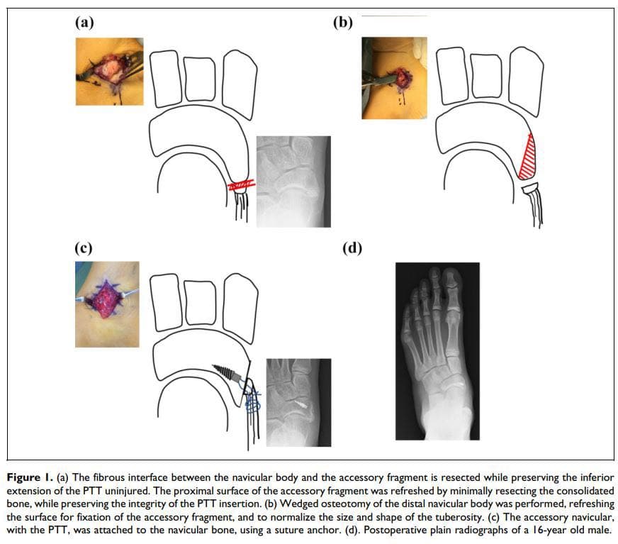 副舟狀骨切除手術 - B251 留言 | Dcard