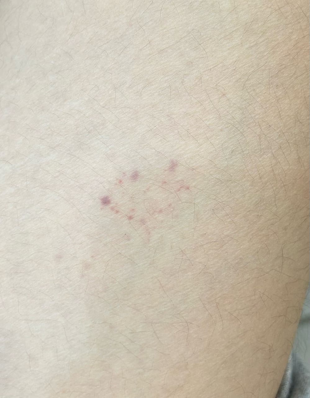抓癢抓到紅紅一點一點的 心情板 Dcard