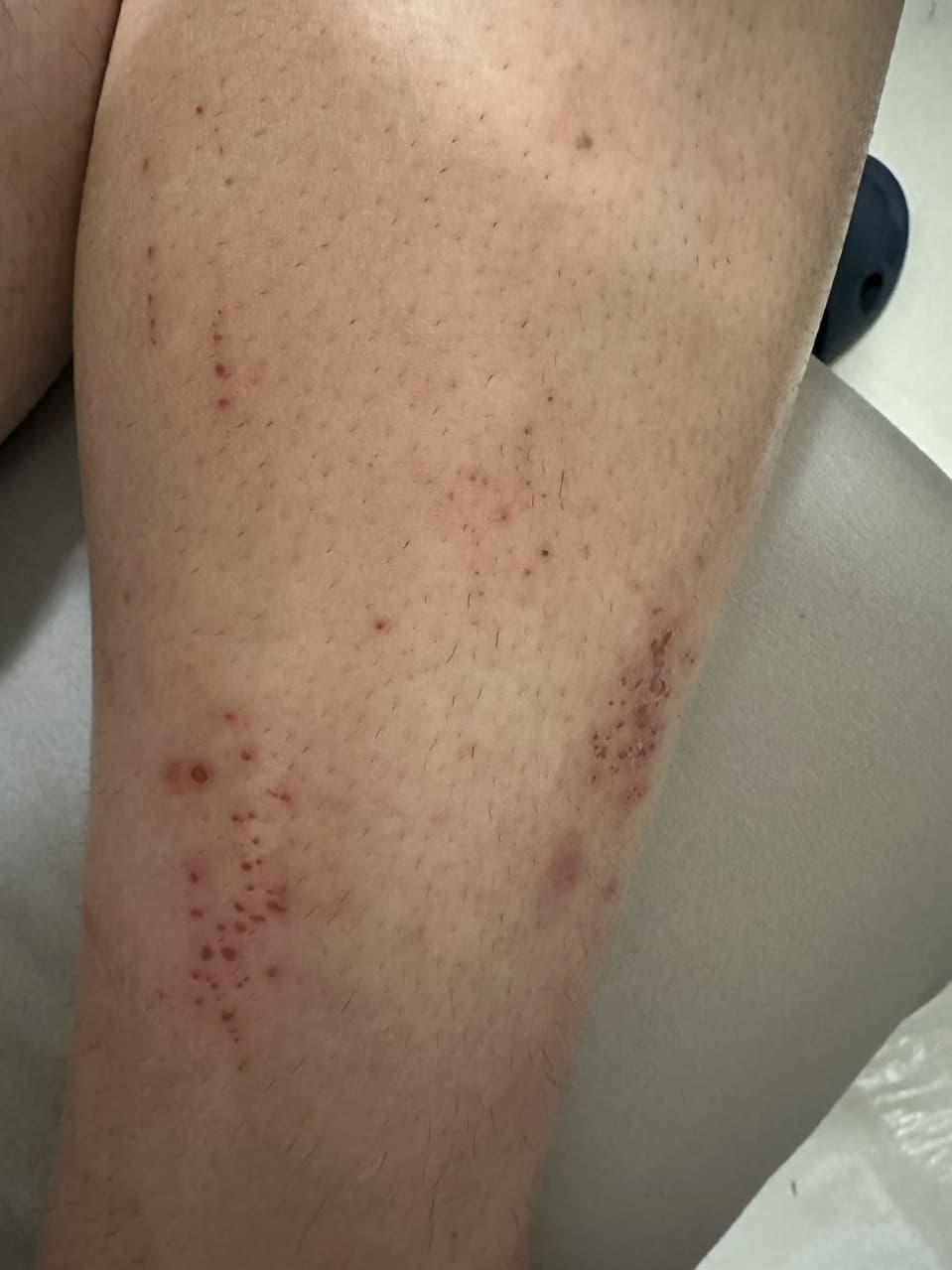發問 請問這是什麼蟲咬 問答板 Dcard