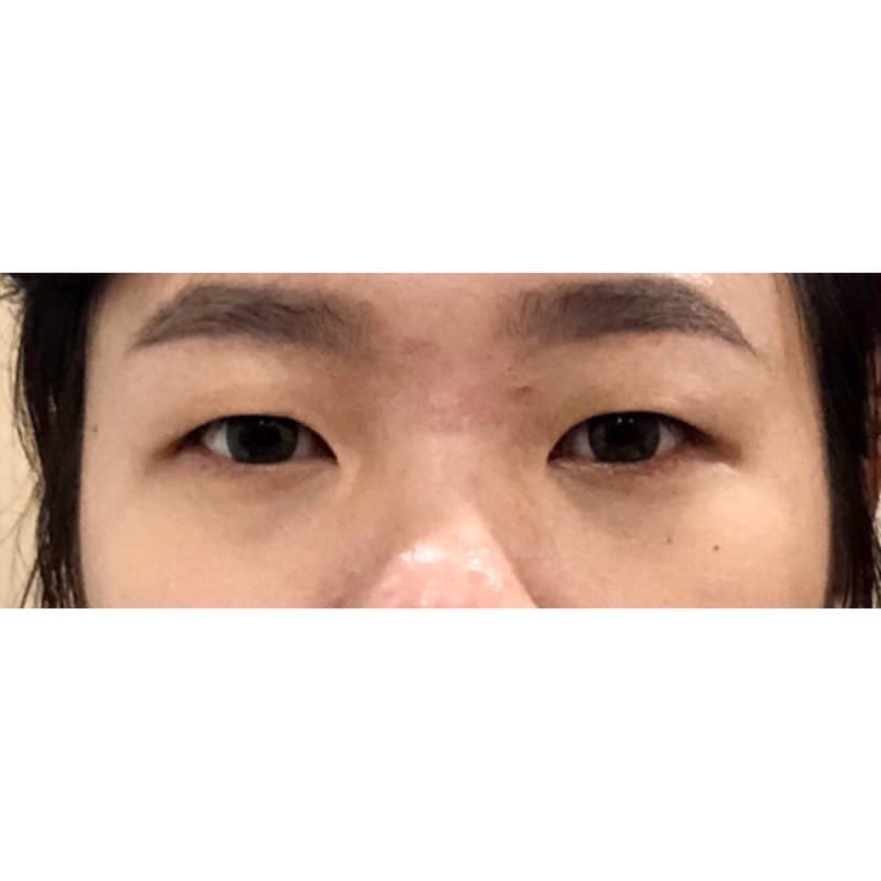 雙眼皮不專業解說-平行型 - B62 留言 | Dcard