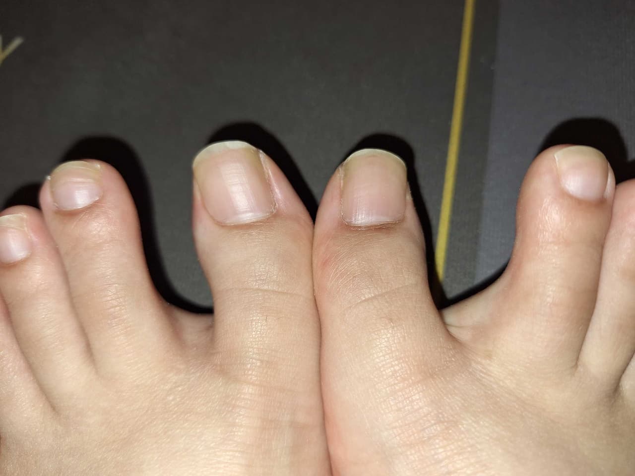 問題 求救!請問這到底是不是甲床分離 美甲板 Dcard