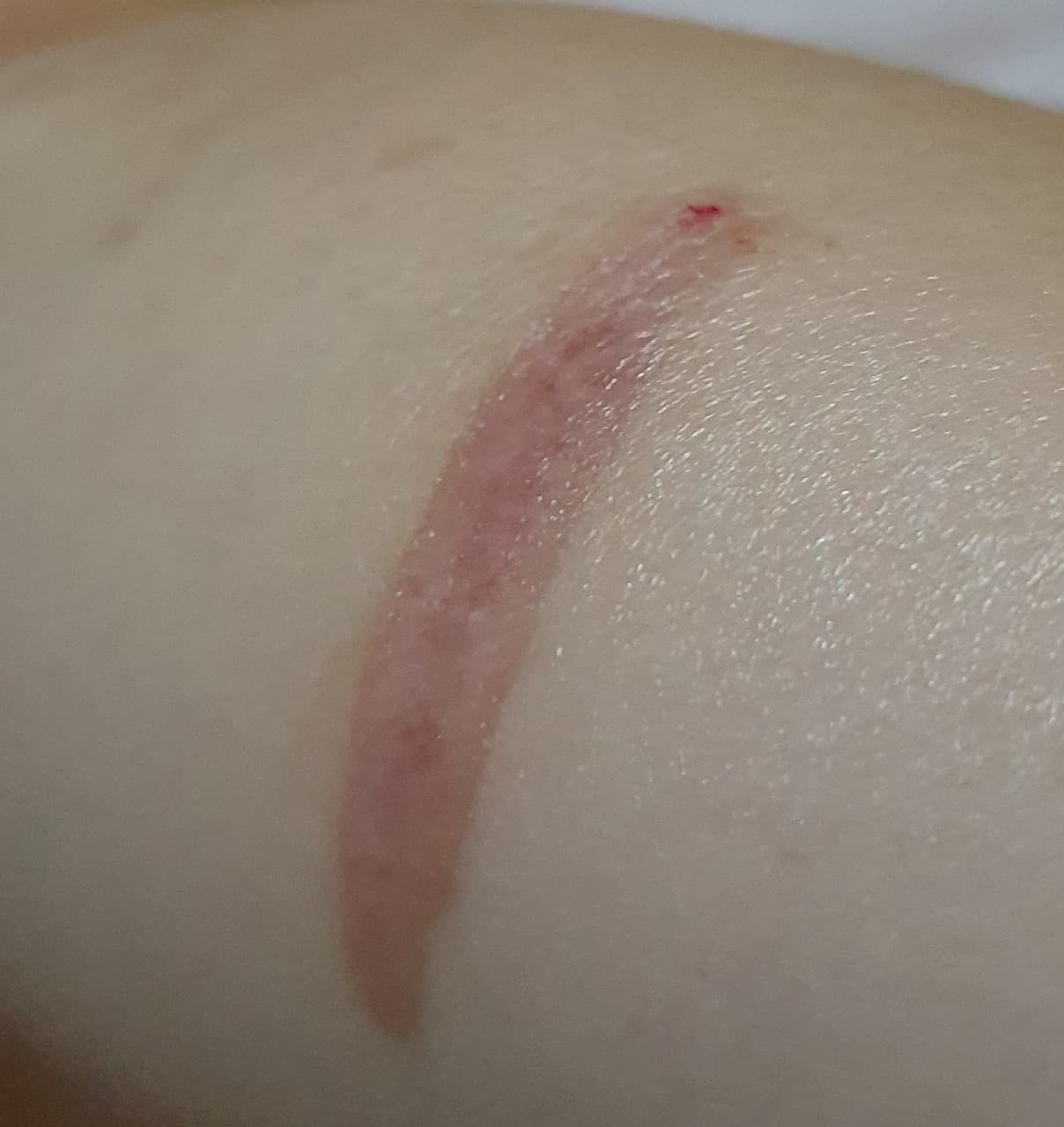 發問 燙傷皮膚變黑 問答板 Dcard