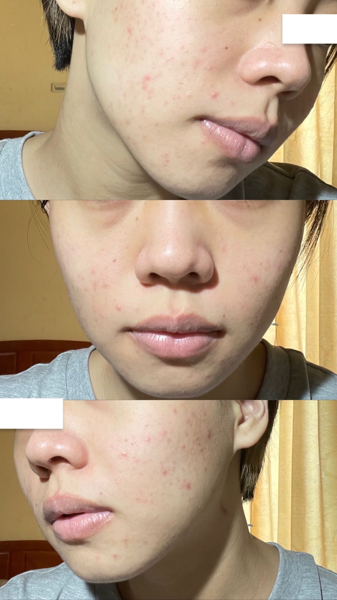 #分享 蠕形蟎蟲一個半月+口服A酸三個月的治療過程 - 美妝板 | Dcard