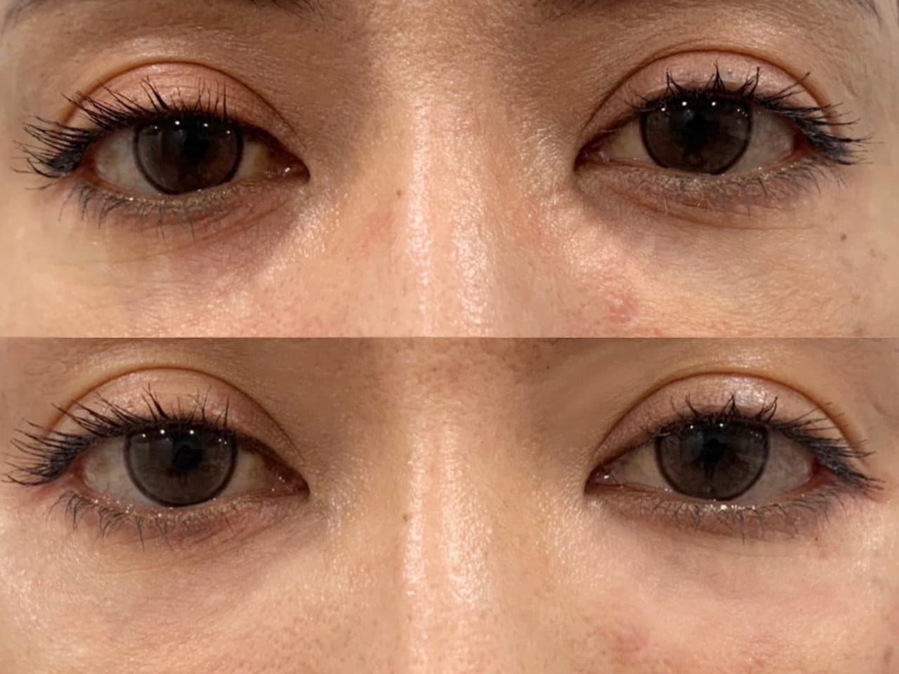 #分享 眼周細紋打玩美電波真的有用！ - 醫美板 | Dcard