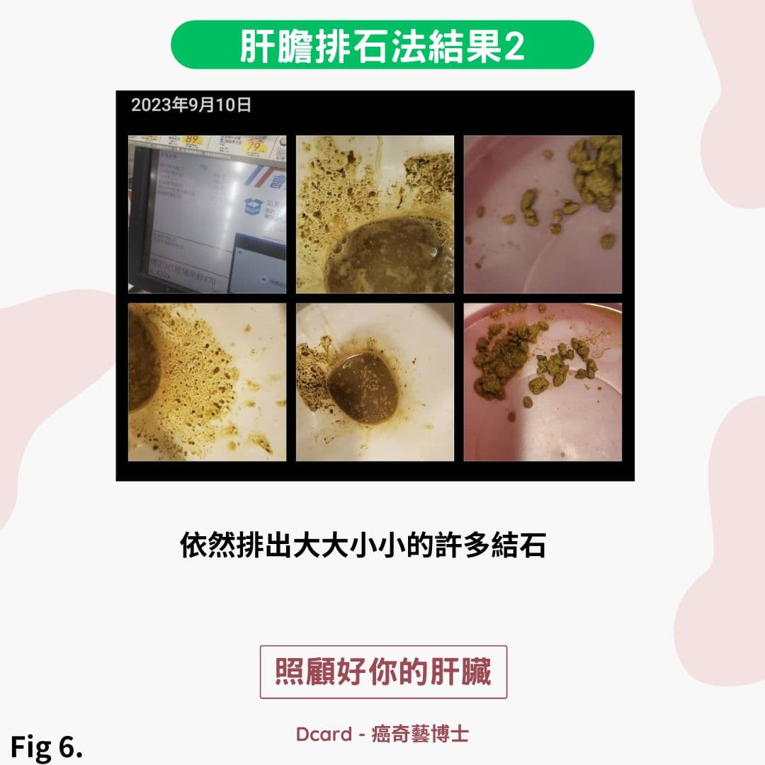 肝膽排石法的3次實際體驗過程與心得(文長，有屎照) - 癌奇藝博士 (@gd810424) | Dcard