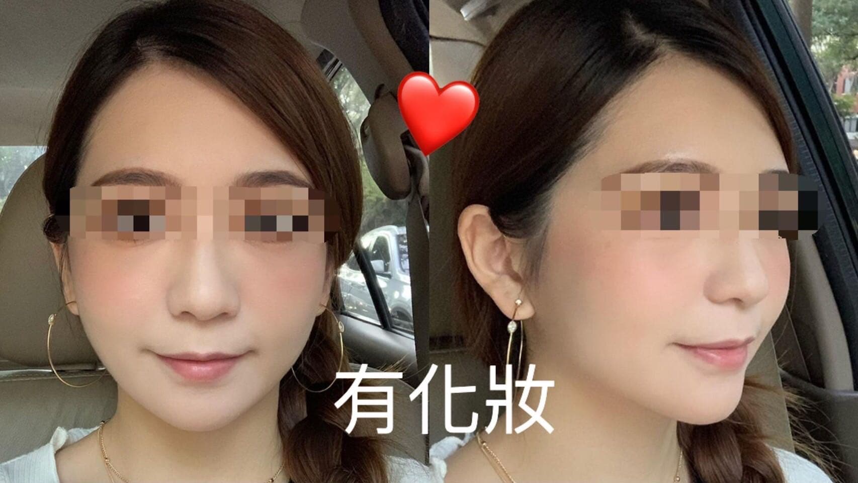 分享 神一般的拯救淚溝型黑眼圈 醫美板 Dcard