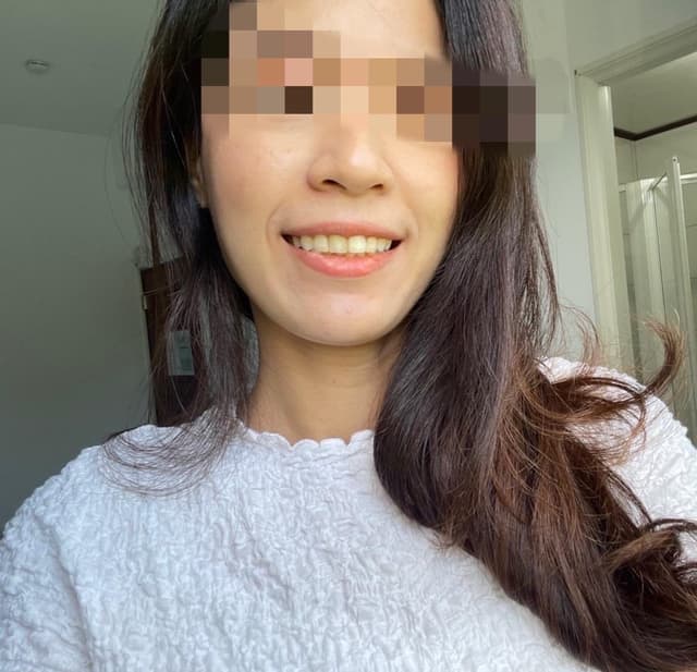 #分享 台北超有感皮秒蜂巢雷射！爆痘人的急救好夥伴🥺 - 醫美板 | Dcard