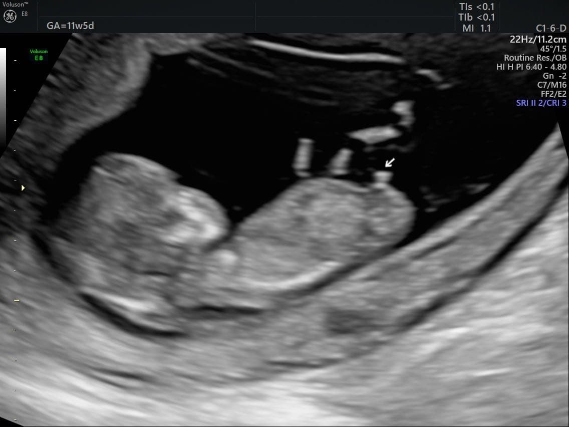 #懷孕 11w5d 生殖節 - 親子板 | Dcard