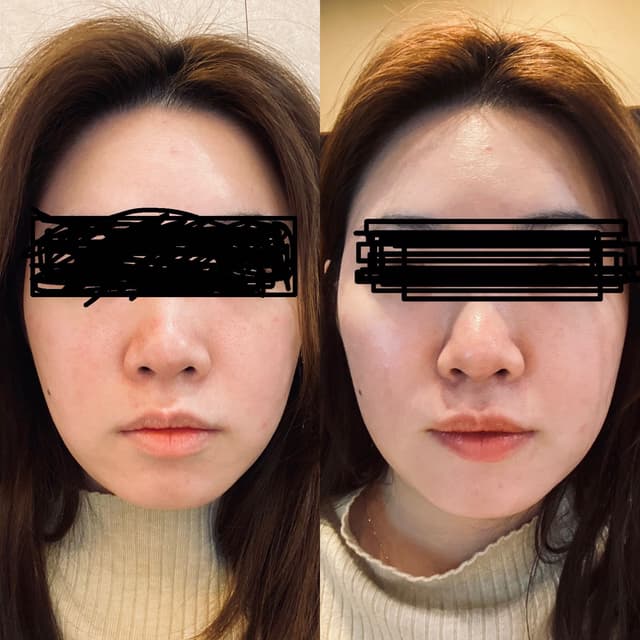 #分享 #分享 釜山醫美V-ro，咀嚼肌肉毒 - 韓國旅遊板 | Dcard