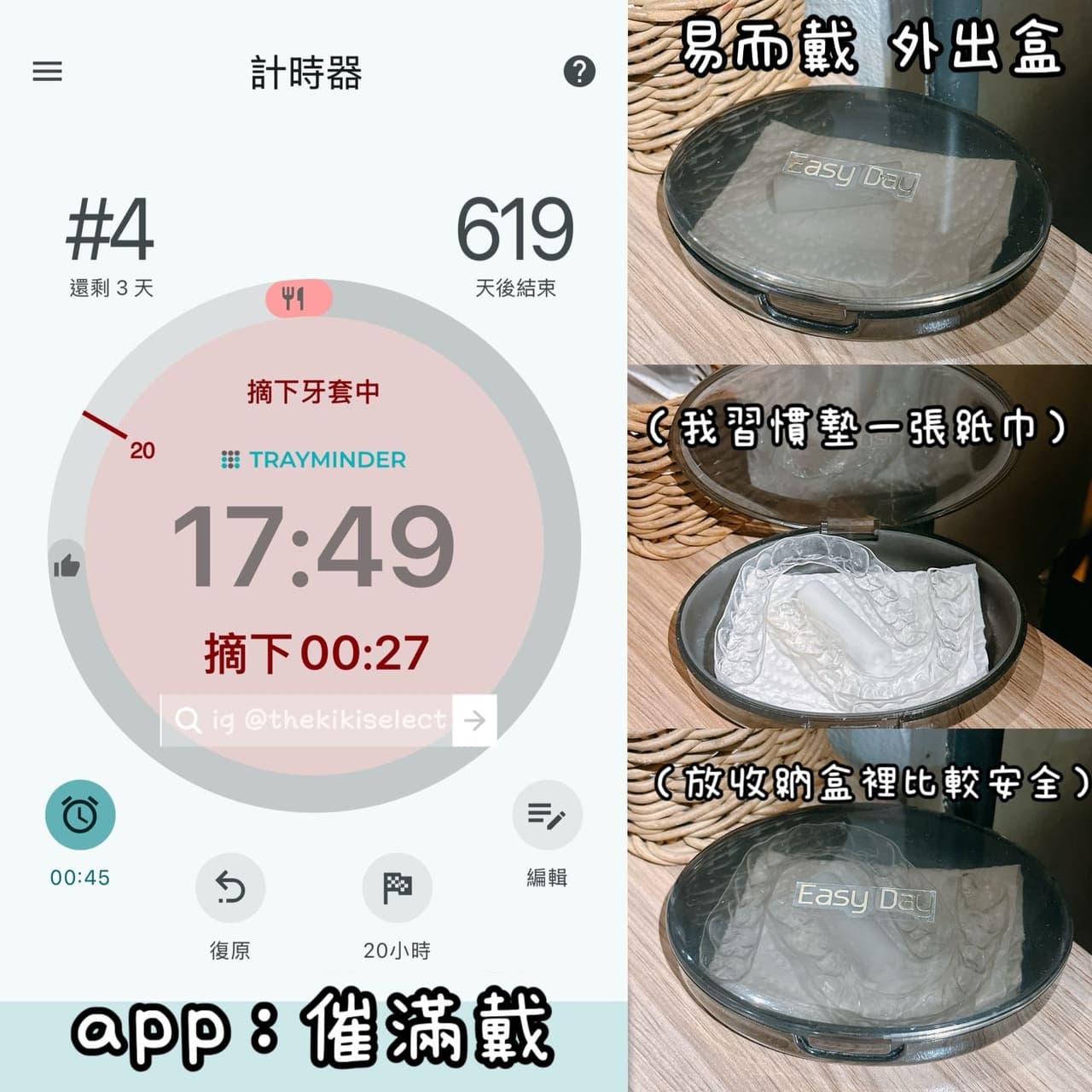 終於開始的矯正⼈⽣ 隱形牙套易⽽戴A1～A5 記錄分享 - 牙齒矯正板 | Dcard