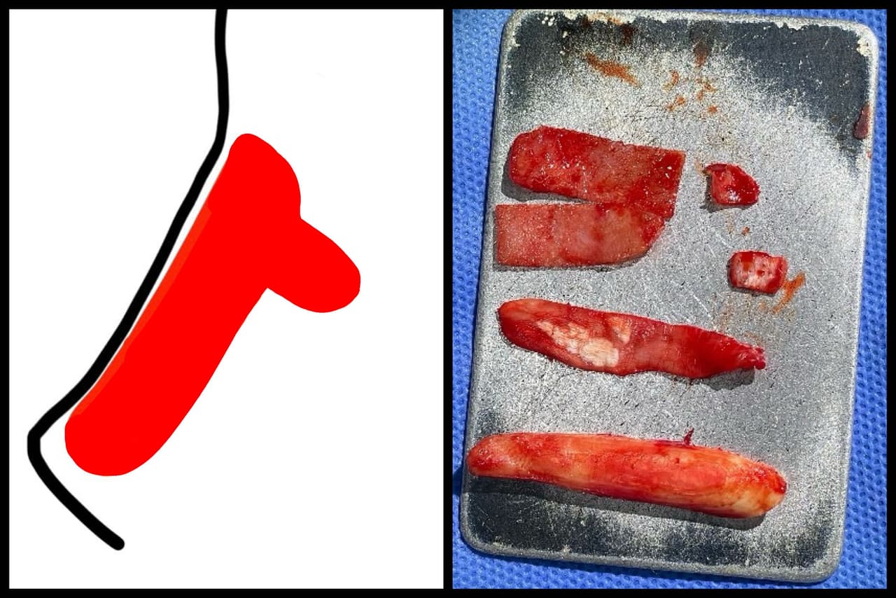 #分享 二次隆鼻/重修鼻5個月 - B155 留言 | Dcard