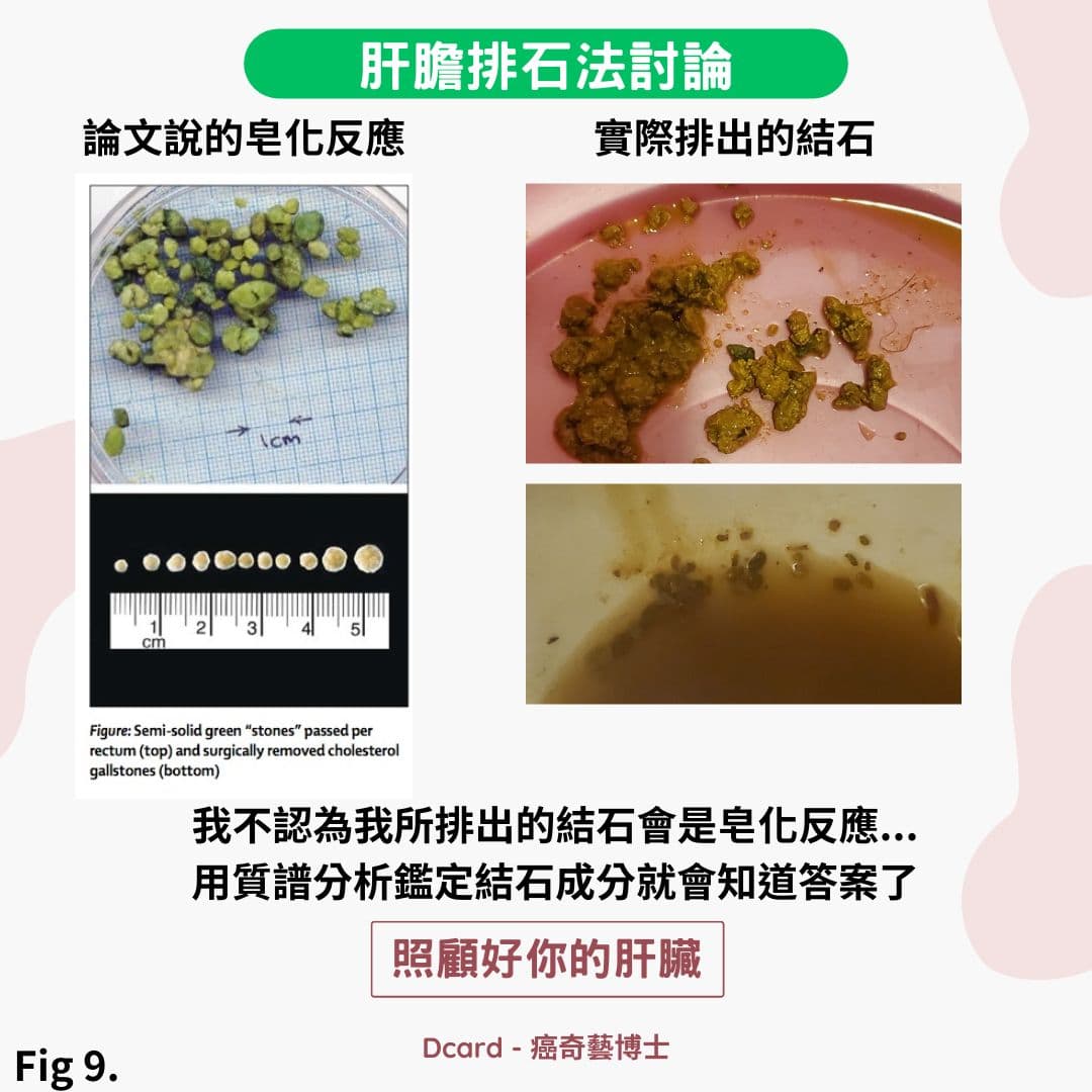肝膽排石法的3次實際體驗過程與心得(文長，有屎照) - 癌奇藝博士 (@gd810424) | Dcard