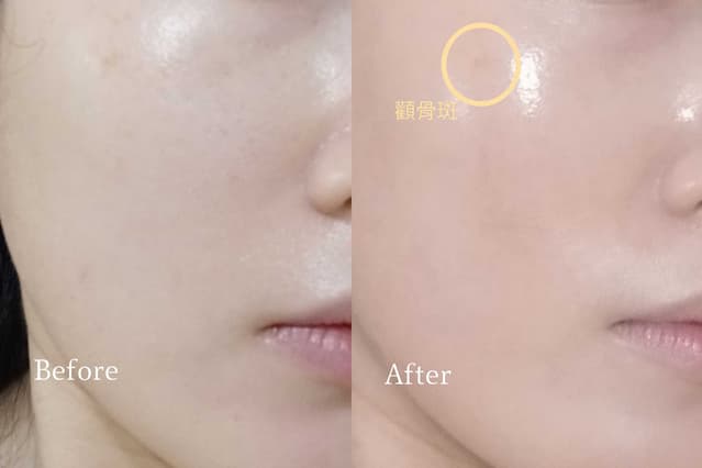 #分享 雀斑救星🎉 雷射過程、術後9天紀錄(Discovery Pico＋Ruby Quanta) - 醫美板 | Dcard