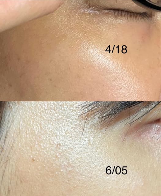 一顆老青春痘，讓我挖掘出 CBD + NMN 延緩老化的功效，膠原蛋白免了拉！ - 閒聊板 | Dcard