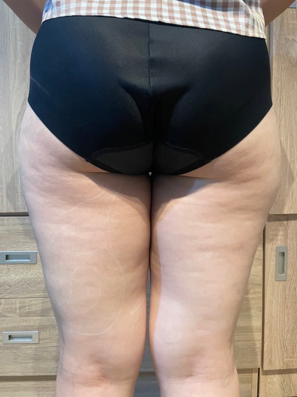 #分享 我不想再當米其林寶寶啦！！ - 晶美整形 (@skin1000) | Dcard