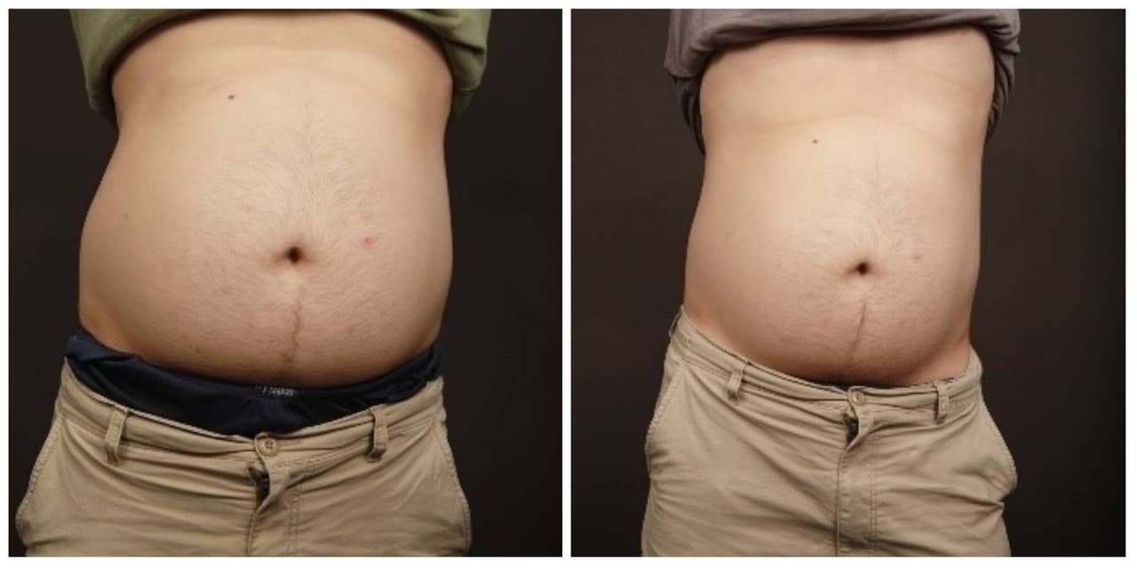 #分享 美X欣CMSlim體驗 - 醫美板 | Dcard