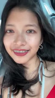 矯正68天的變化 - 牙齒矯正板 | Dcard