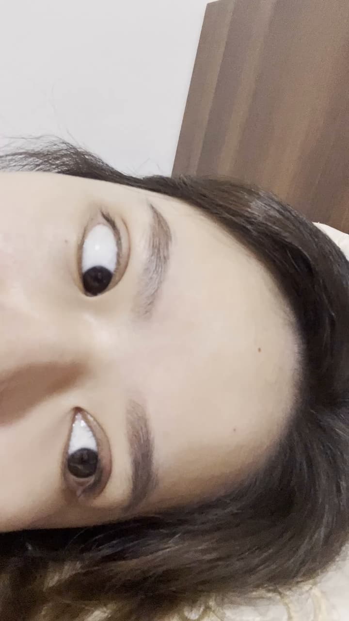 #分享 更）縫雙眼皮1個月 CP值超高！ - 醫美板 | Dcard